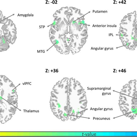 Significant Correlation Between Basbis Score And Neural Activation