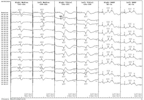 Syed Ahmed Uddin Imran Bsc Reegt Cnim On Linkedin Neuromonitoring Ssep Mep Baep Emg