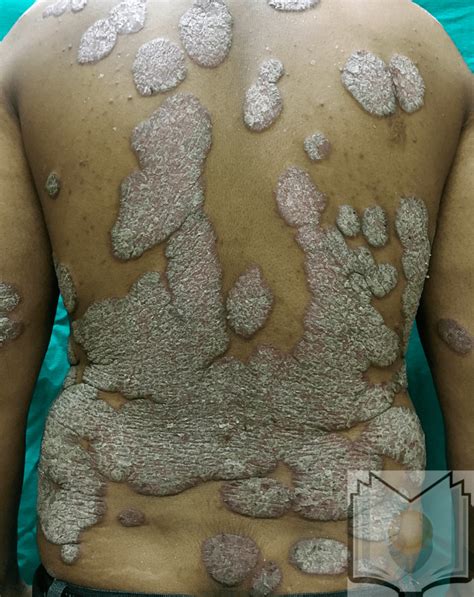 Hyperkeratosis Md Searchlight