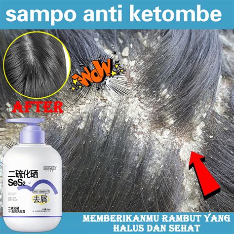 Jual Shampo Anti Ketombe Selenium Sulfide Atasi Ketombe Parah And Gatal Rambut Bersih And Sehat