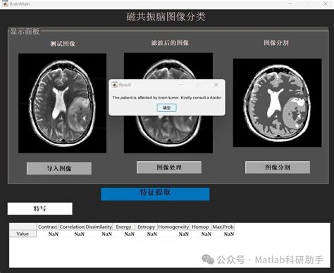【疾病分类】基于支持向量机svm实现核磁共振大脑疾病（脑瘤）分类附matlab代码 svm算法在医学上的应用 csdn博客