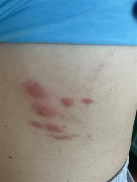 Are These Bed Bug Bites R Bugbites