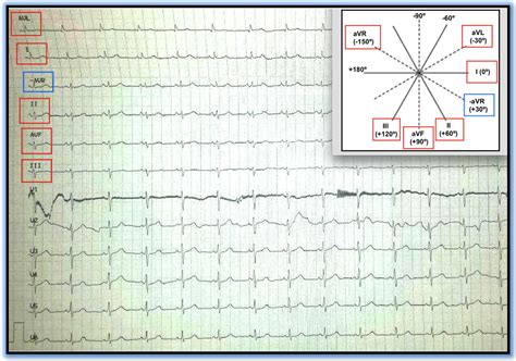 ecg review why are avr waveforms positive … relias media