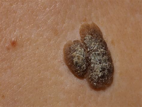 Seborrheic Keratoses Treatment Causes And Dermatitis Dr Michele Green