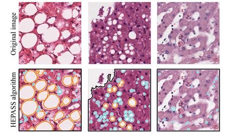 Fully Automated Quantitative Assessment Of Hepatic Steatosis In Liver