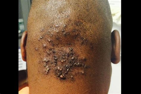 Dermdx Papular Lesions On The Scalp Dermatology Advisor