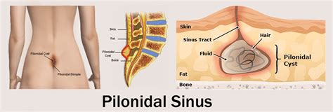 Pilonidal Sinus Surgiplus Hospital