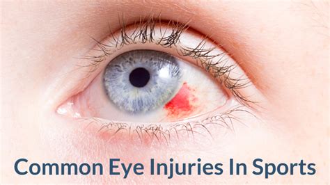 The Most Common Sports Related Eye Injuries Eyepromise