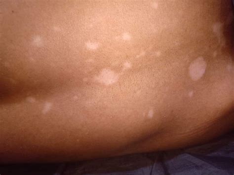 Managing Case Of Leukoderma Dr Santosh Patani