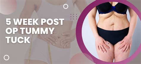 5 Week Post Op Tummy Tuck Dr Vinod Vij