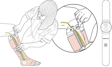Fitting The NMES Device To The Leg In The Presence Of Compression Bandaging Download