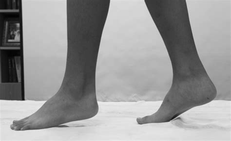 A Clinical Photograph Of The Patient Shows Tip Toe Gait During Standing