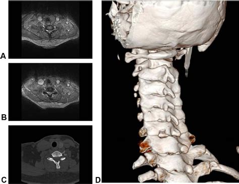 Endoscopic Cervical Decompression At Donte Galiano Blog