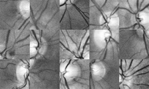 Github Deeptrial Optic Disc Unet Attention Unet Model With Post Process For Retina Optic Disc