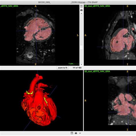 Itk Snap Segmentation Itk Toolbox On The Left Side Of The Screen Download Scientific Diagram