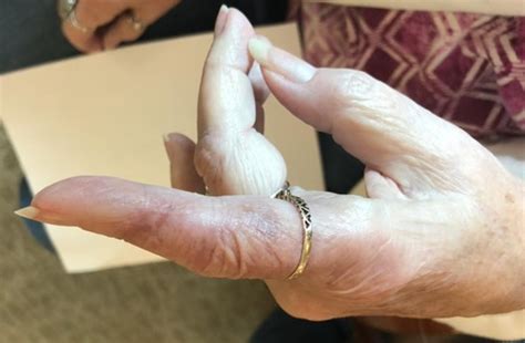 Pyoderma Gangrenosum Of Finger Best Wound Practice