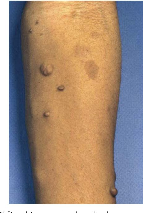 [pdf] Clinical Manifestations And Management Of Neurofibromatosis Type