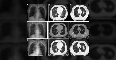 Hyperpyrexia And Chest Tightness Following Waterproofing Spray Exposure Medsynapse