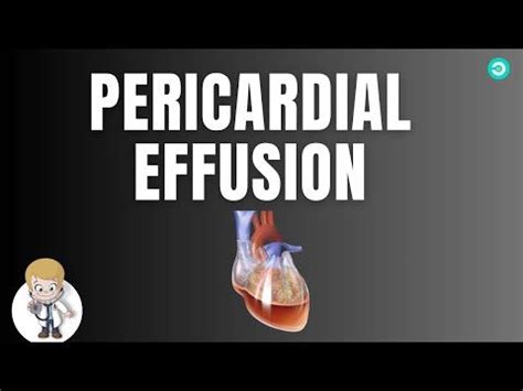 Pericardial Effusion Sign And Symptoms Pathophysiology Diagnosis