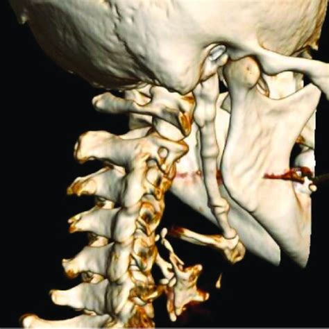 Right Styloid Process 7561 Mm As Measured By Ct Scan Multiplanar