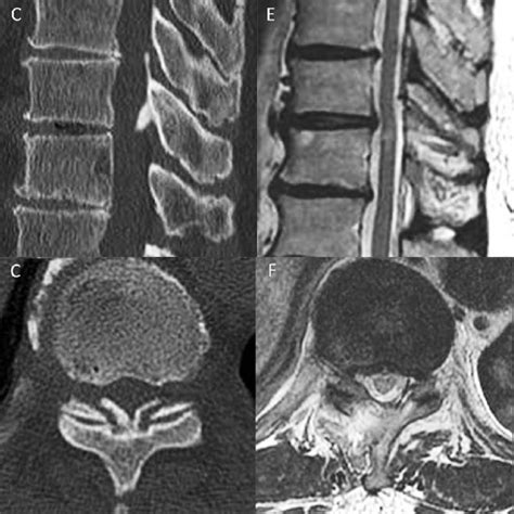 Joa Scoring System For Thoracic Myelopathy Download Scientific Diagram