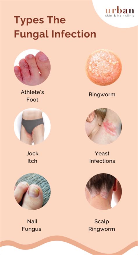 Fungal Skin Infections Types