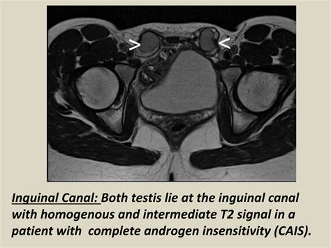 Presentation1 Radiological Imaging Of Undescended Testis Pptx