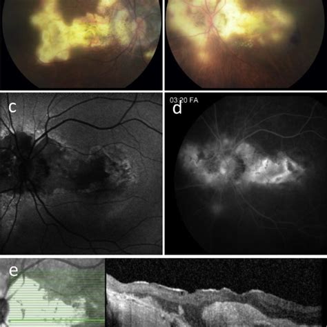Peripapillary Choroidal Neovascular Membrane With Adjacent Hemorrhage Download Scientific Diagram