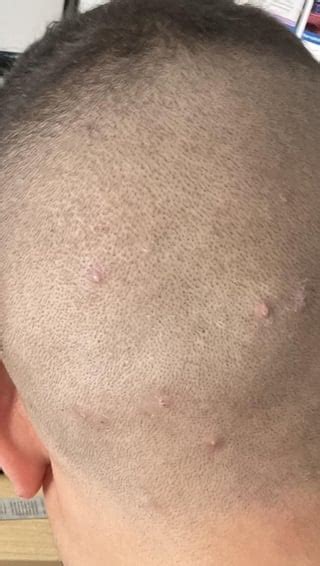 Help With My Scalp Folliculitis R Folliculitis