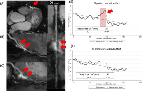 si profile curve assessment with an obvious artifact a original image