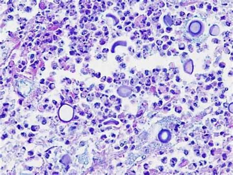 Cryptococcosis Causes Symptoms And Treatment Britannica