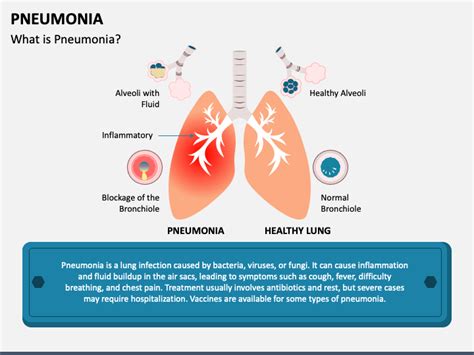Pneumonia Slide Aspiration Pneumonia Information Mount Sinai New