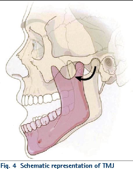 Reduction Of Temporomandibular Joint Dislocation An Ancient Technique That Has Stood The Test