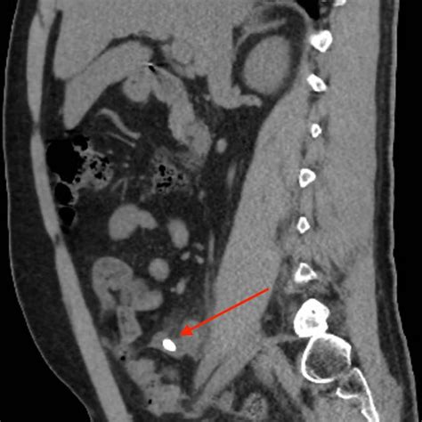 Sagittal Ct Image Of The Abdomen And Pelvis Without Contrast Sagittal