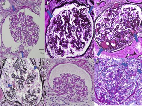 Consensus Definitions For Glomerular Lesions By Light And Electron