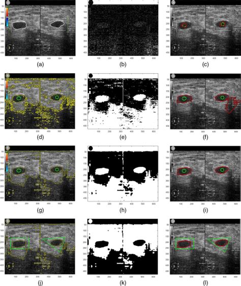 Combinatorial Active Contour Bilateral Filter For Ultrasound Image Segmentation