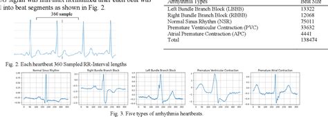 Figure 3 From Arrhythmia Detection With Custom Designed Wavelet Based Convolutional Autoencoder
