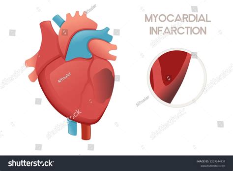 Unhealthy Human Heart Myocardial Infarction Disease Stock Vector