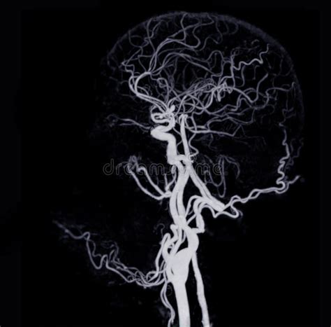 Ct Angiography Of The Brain Or Cta Brain Showing Cerebral Aryery Stock