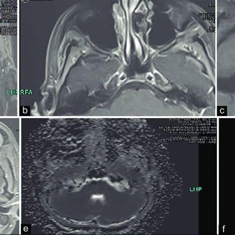 T2 A Post Contrast T1 B T1 C Post Contrast T1 D Dw E Adc