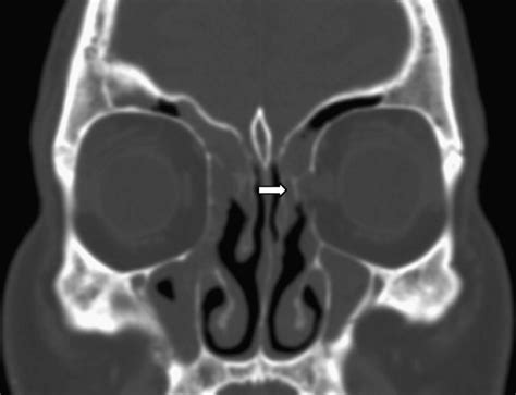 The Prevention And Management Of Complications In Ethmoid Sinus Surgery