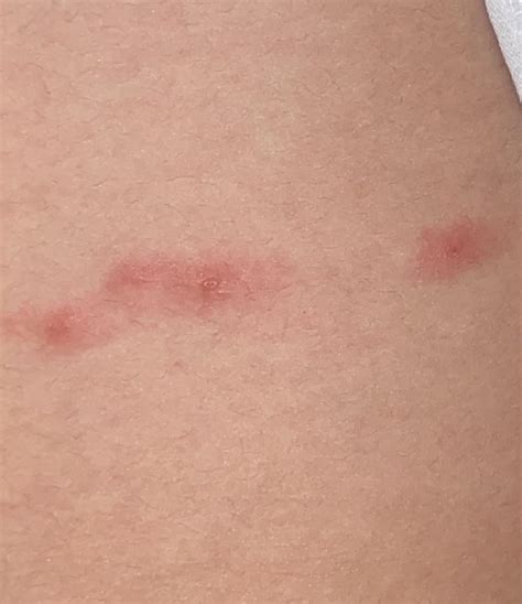 Could This Be Shingles Rshingles