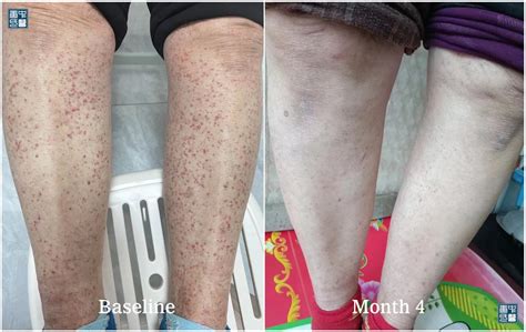 Iga Vasculitis Henoch Schönlein Purpura In The Elderly 老年过敏性紫癜一例 Tangs Clinical Tcm