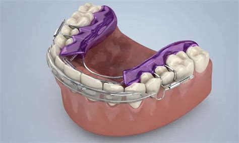 Tooth Alignment Case Studies Market House Dental Practice
