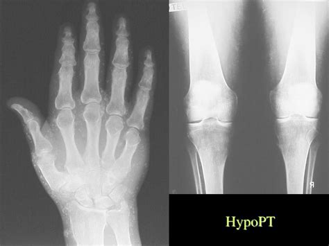Ppt Soft Tissue Calcification And Ossification Powerpoint Presentation Id 1231405