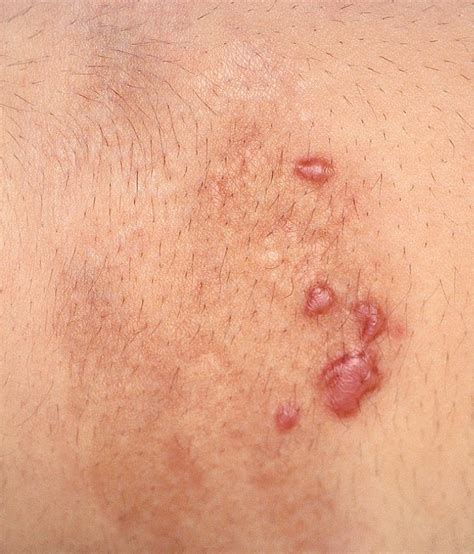 Morphea And Lichen Sclerosus Clinical Tree