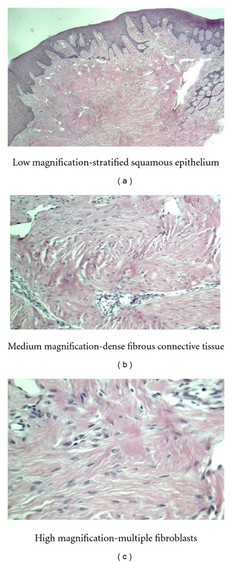 Fibroma Histology