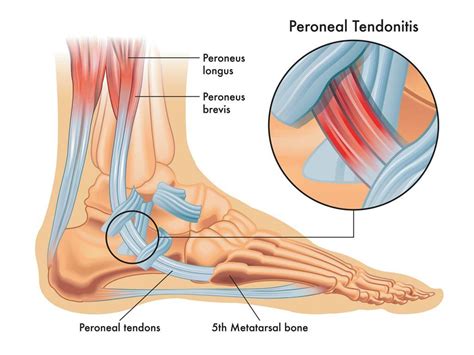 Peroneal Tendon Subluxation Arthurcare