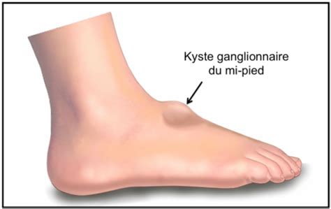 Boule Au Dessus Du Pied Boule Aux Pieds Causes Symptômes Et