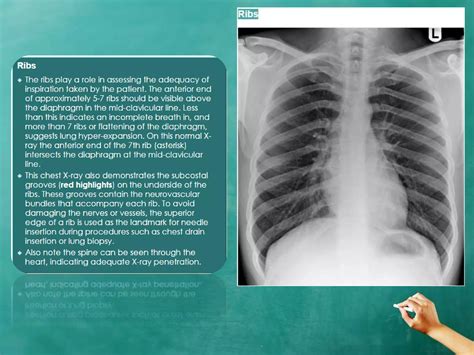 Chest X Ray Anatomy How To Interpret Chest X Ray 2 PPTX